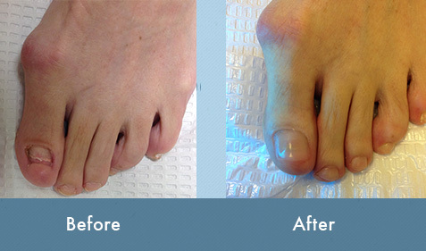 Before & After | First Coast Foot Clinic